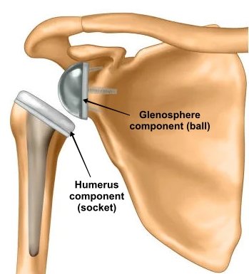 Reverse Shoulder Replacement Chennai | Shoulder Arthritis | Shoulder ...
