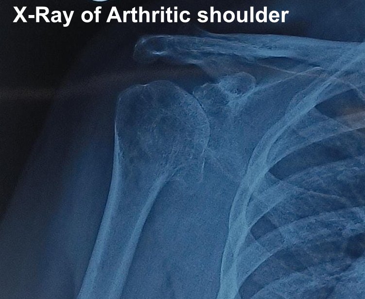 Shoulder Arthritis Chennai | Cartilage Injury Chennai | Bone Spurs Chennai